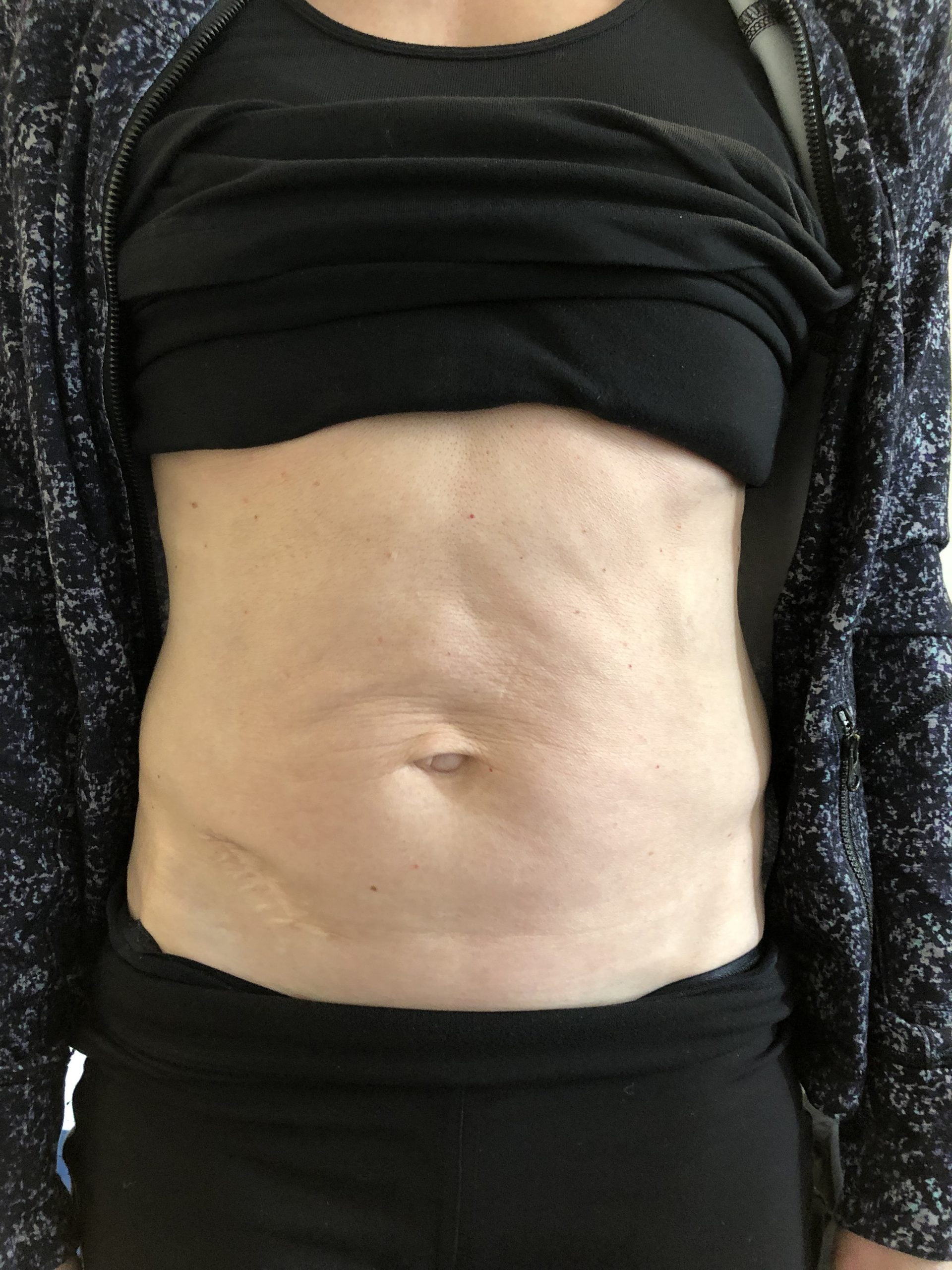 What is DR? -a new series of blogs on diastasis recti - The Center For ...